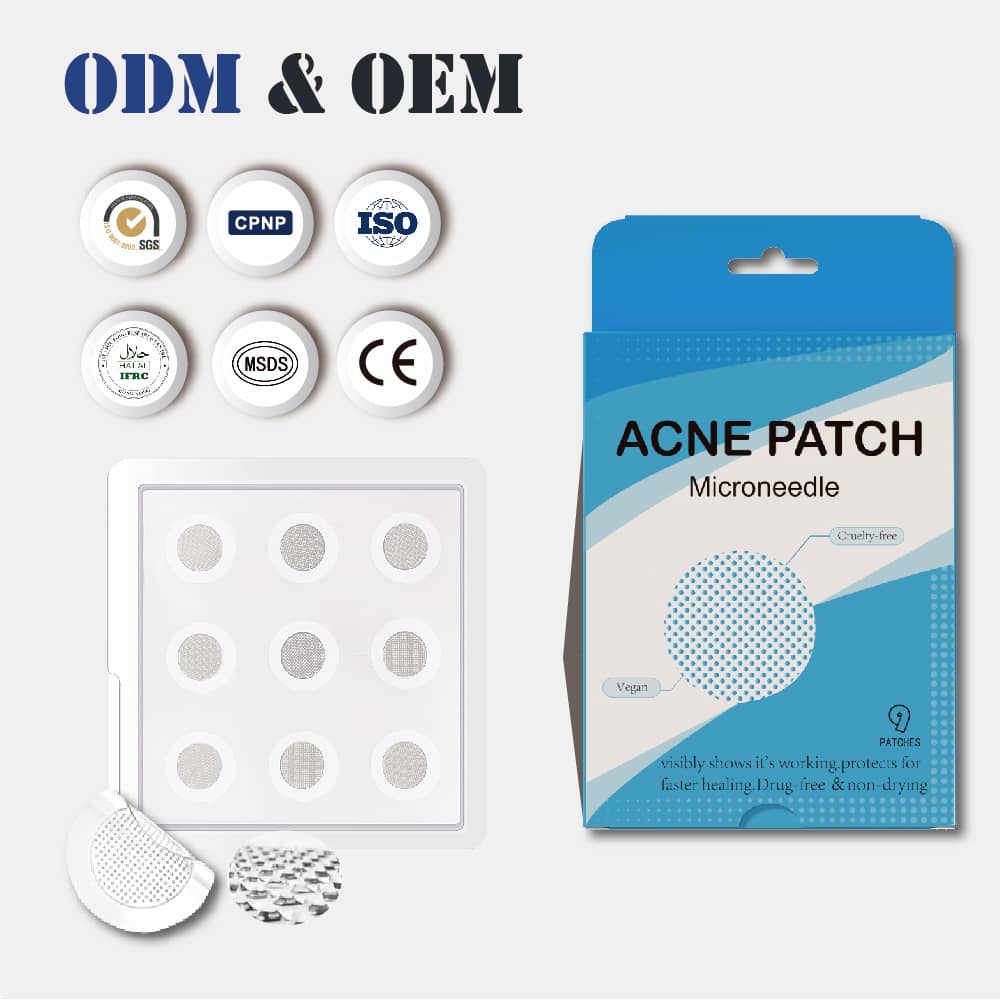 Customized Dissolving Microneedle Acne Patch
